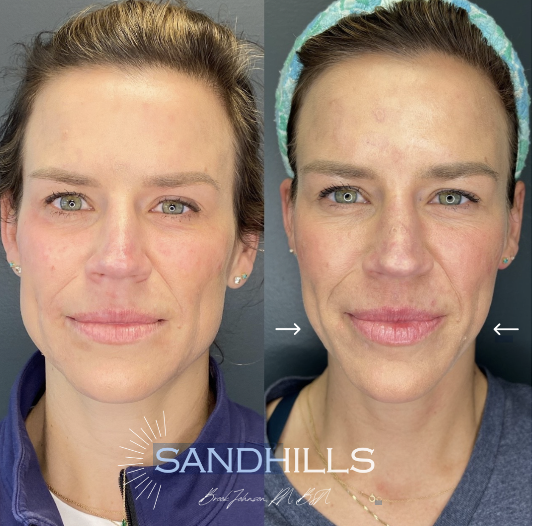 Masseter Slimming With Botox Sandhills Oral Facial Surgery